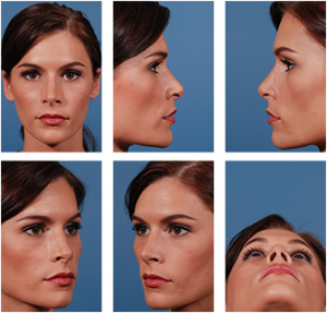Online Virtual Rhinoplasty Consultation Dallas Fort Worth TX